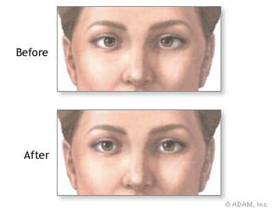 Qu'est ce que le strabisme ? - Le Blog Lunettes